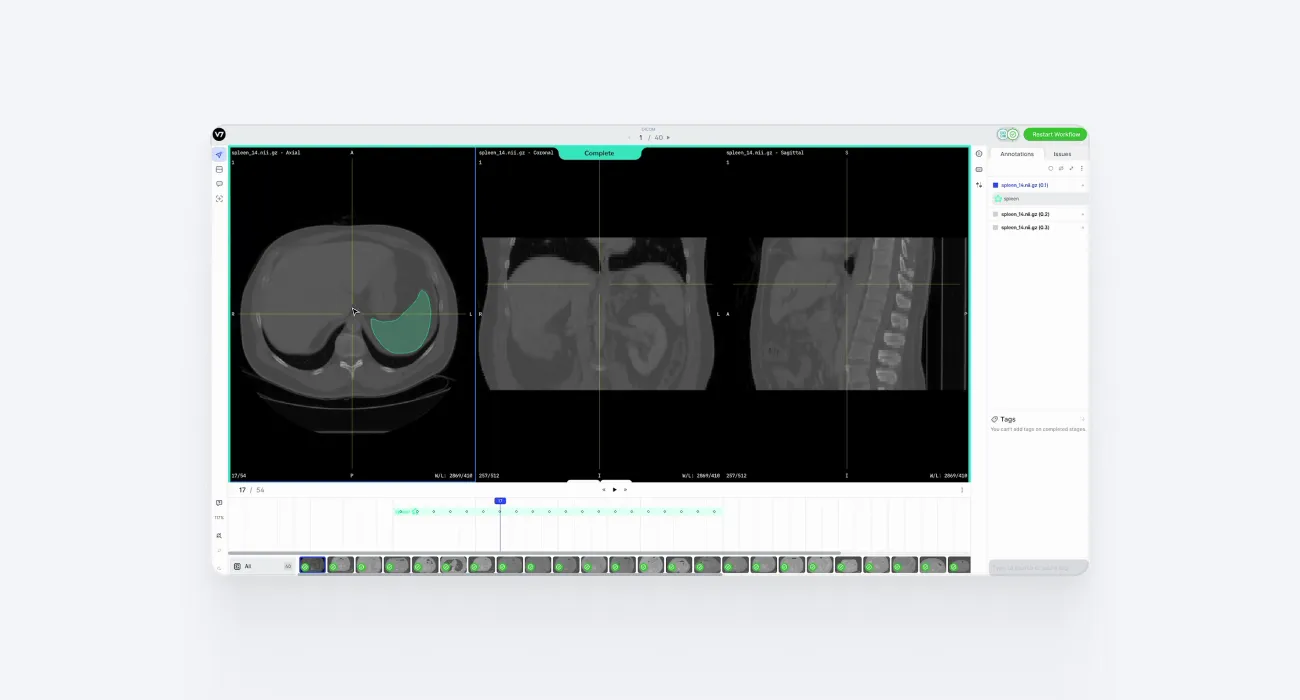 V7’s Integration With SageMaker: Transforming Radiology AI